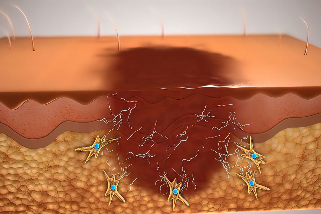 Diabetic Wounds in Los Angeles, CA | Diabetic Foot Ulcers