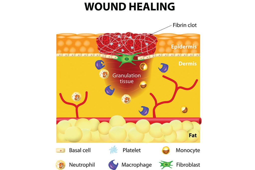 Diabetic Wounds in Los Angeles, CA | Diabetic Foot Ulcers