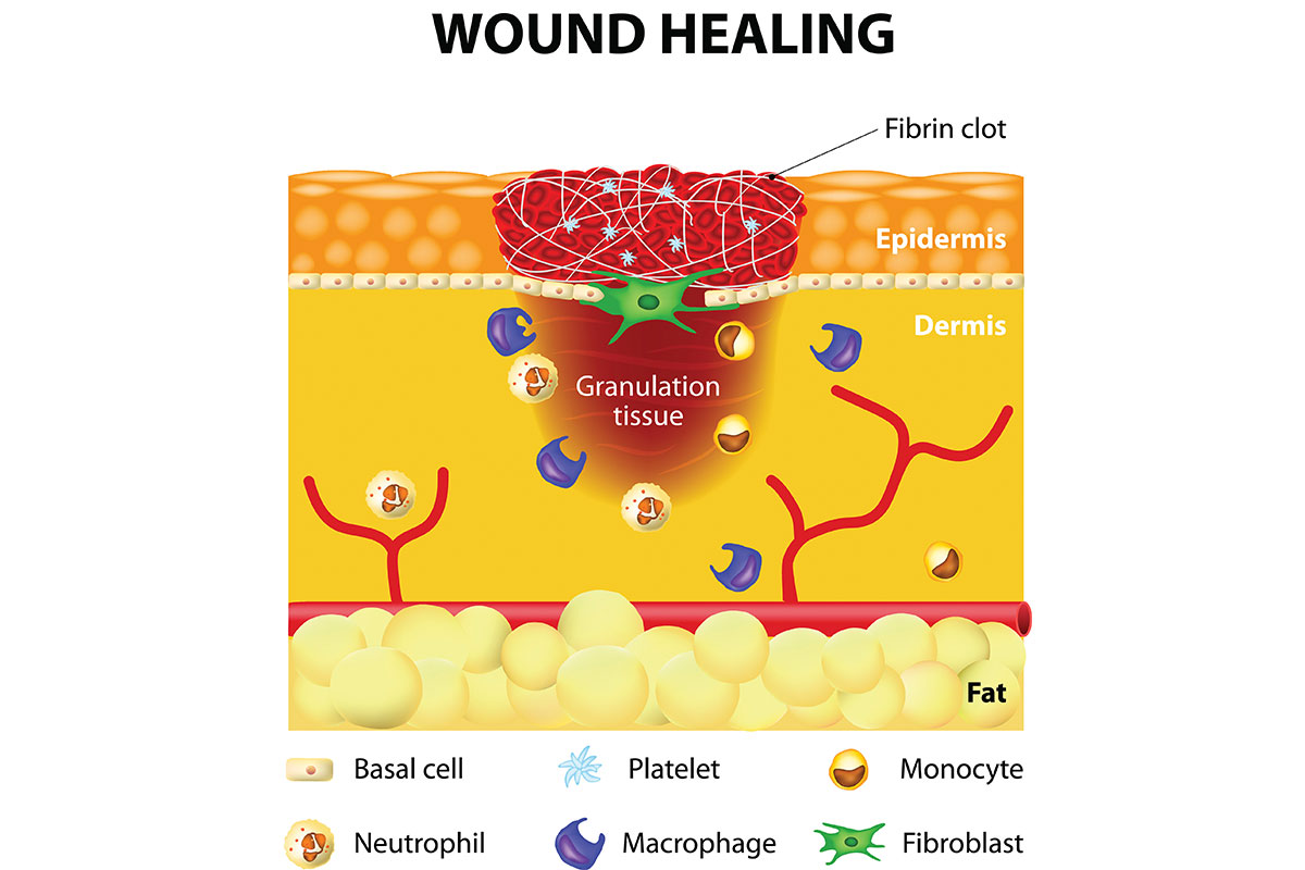 Diabetic Wounds in Los Angeles, CA | Diabetic Foot Ulcers