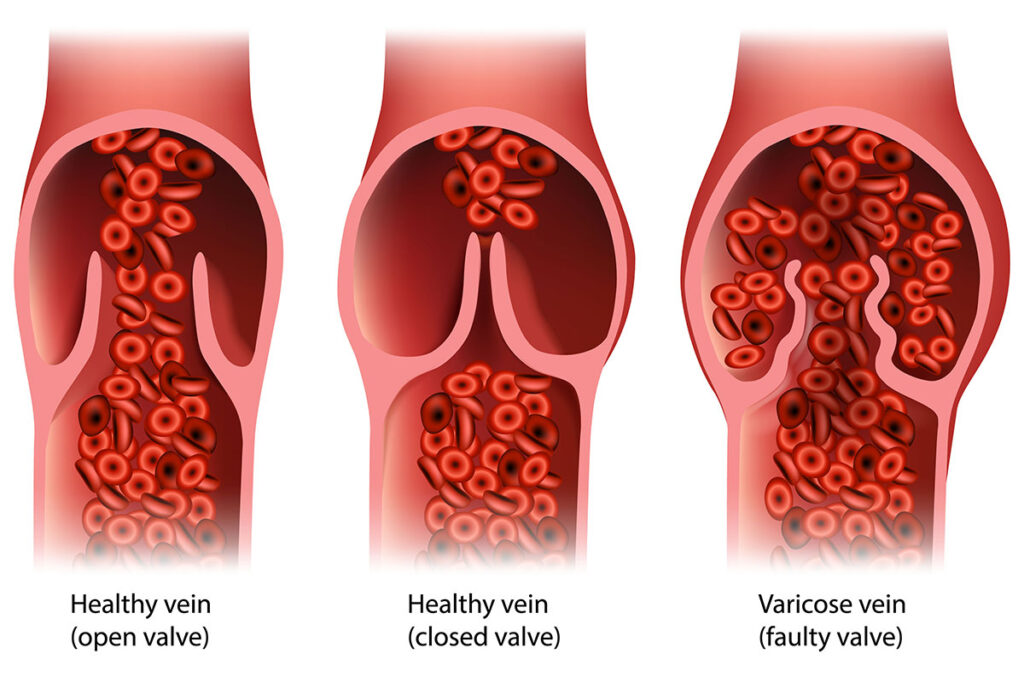 Venous Wounds in Los Angeles, CA | Wound & Burn Centers