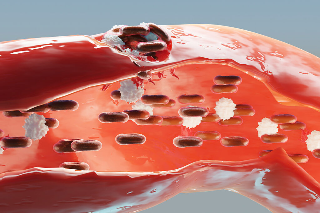 Acute Wounds Los Angeles, CA | Wound & Burn Centers of America