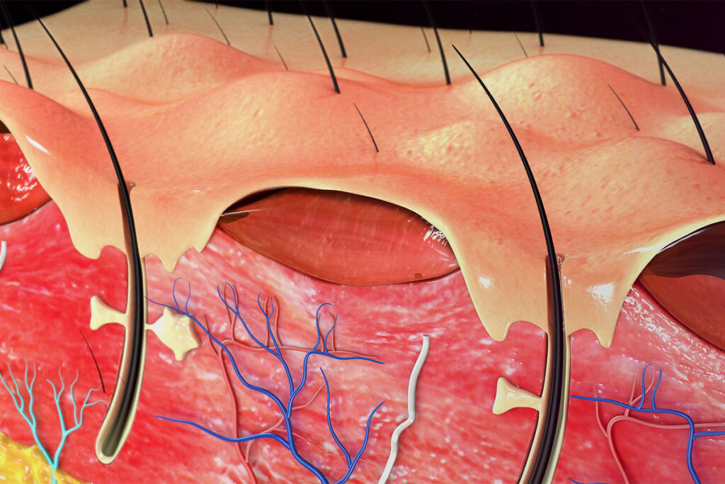 Burn Injuries Los Angeles, CA | Wound & Burn Centers of America