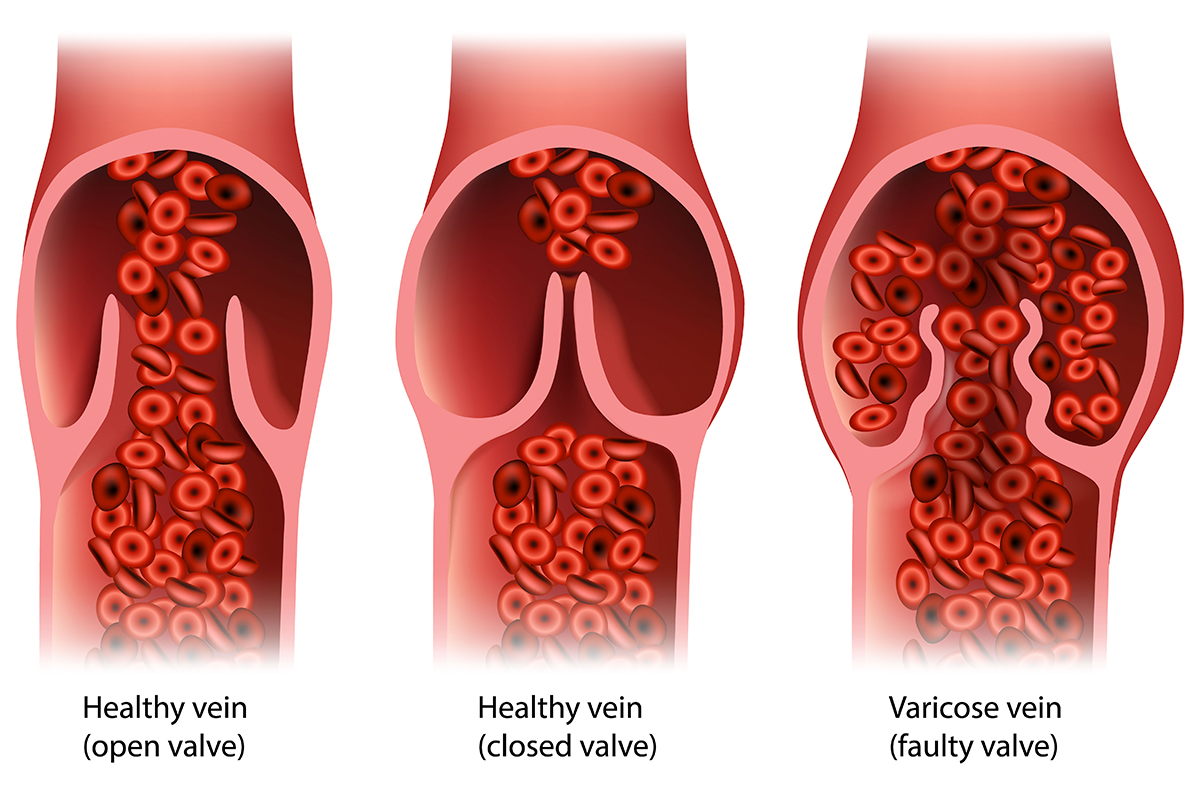Lower Extremity Vein Treatment in Los Angeles, CA | Spider Veins