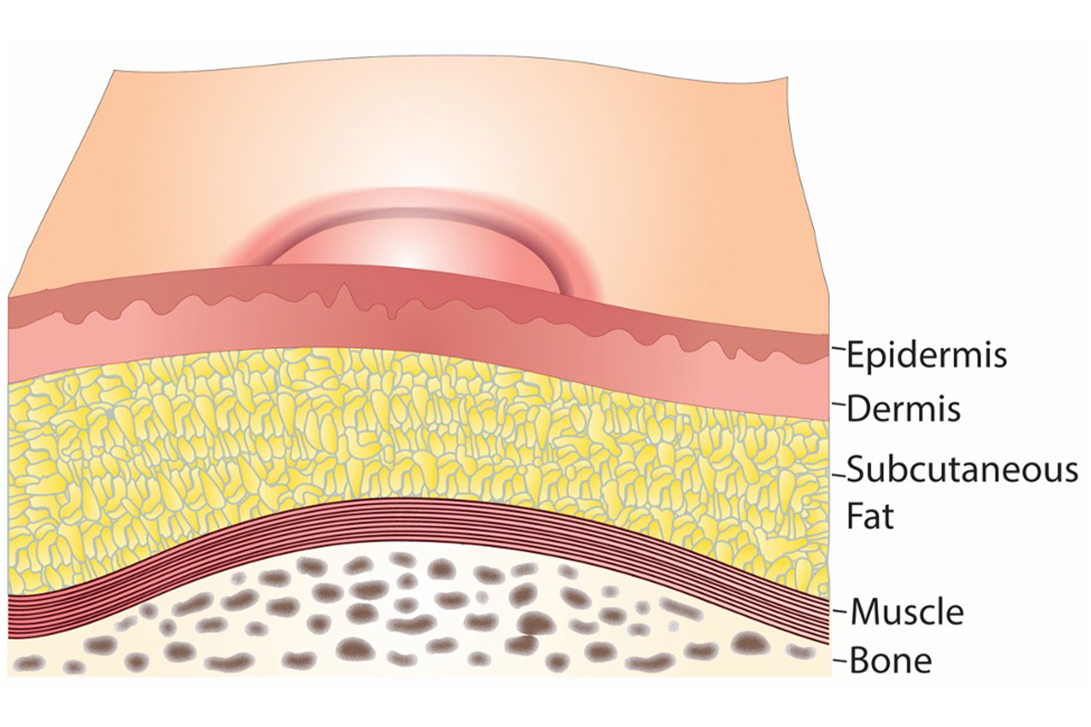 Pressure Injuries in Los Angeles, CA | Bedsores | Pressure Sores