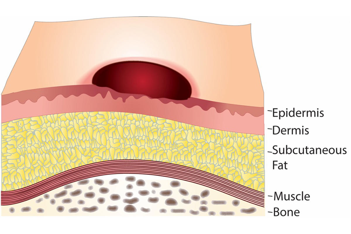Pressure Injuries in Los Angeles, CA | Bedsores | Pressure Sores