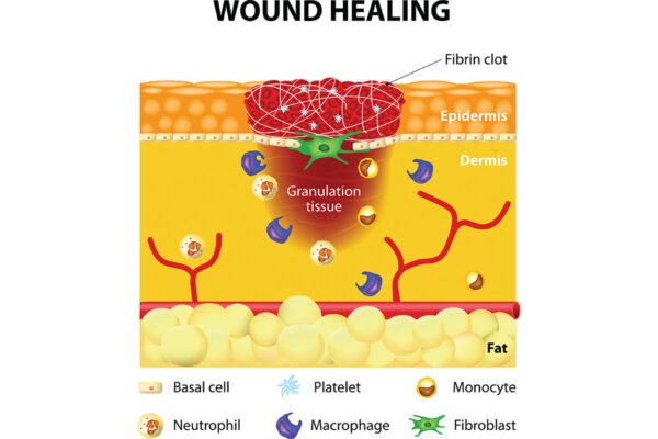 Wound Debridement in Los Angeles, CA | Wound & Burn Centers