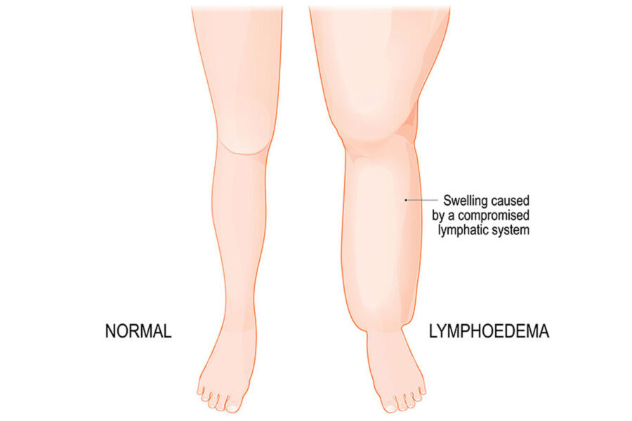 Complex Wounds With Systemic Diseases & General Conditions