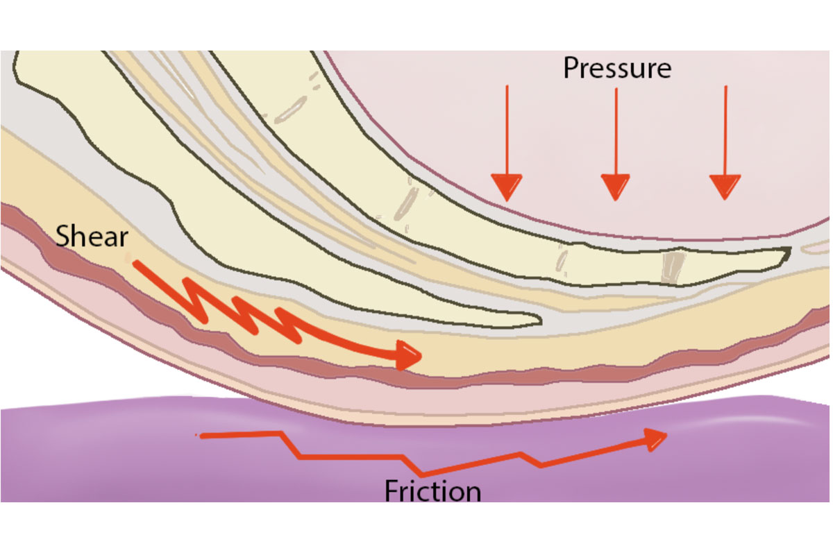 Pressure Injuries in Los Angeles, CA | Bedsores | Pressure Sores